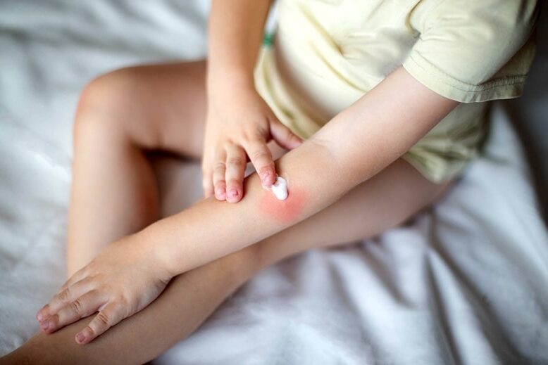 Urticaria (Hives) Care Plan for Children | K Health