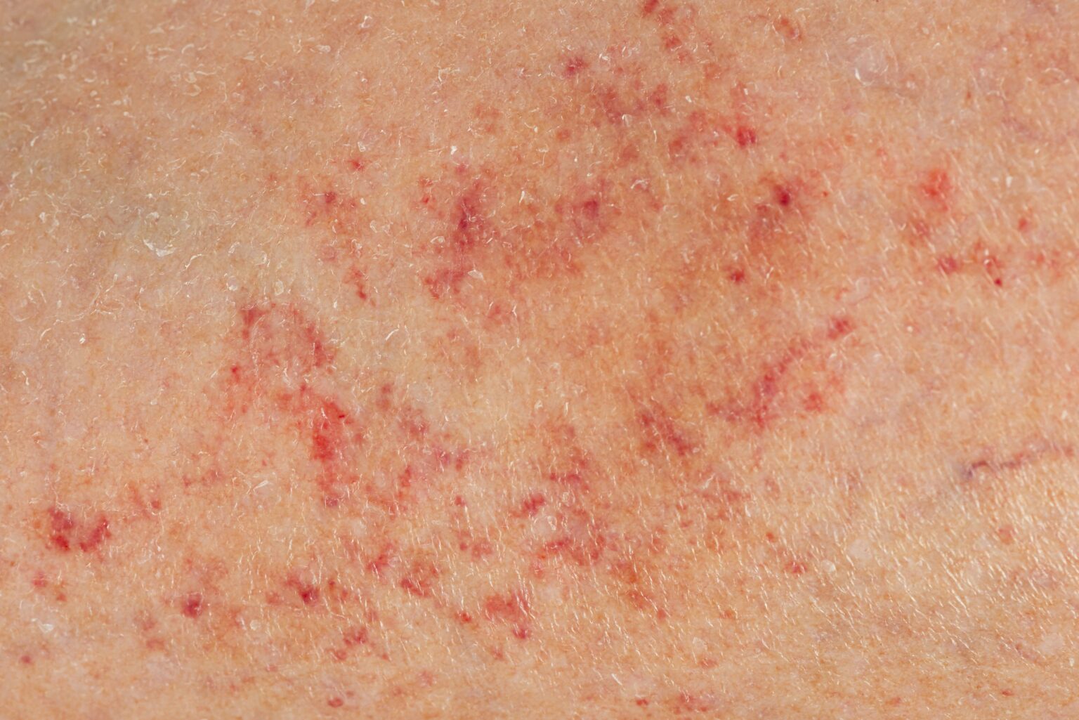 Petechiae: Learn The Symptoms, Causes, and Treatments - K Health