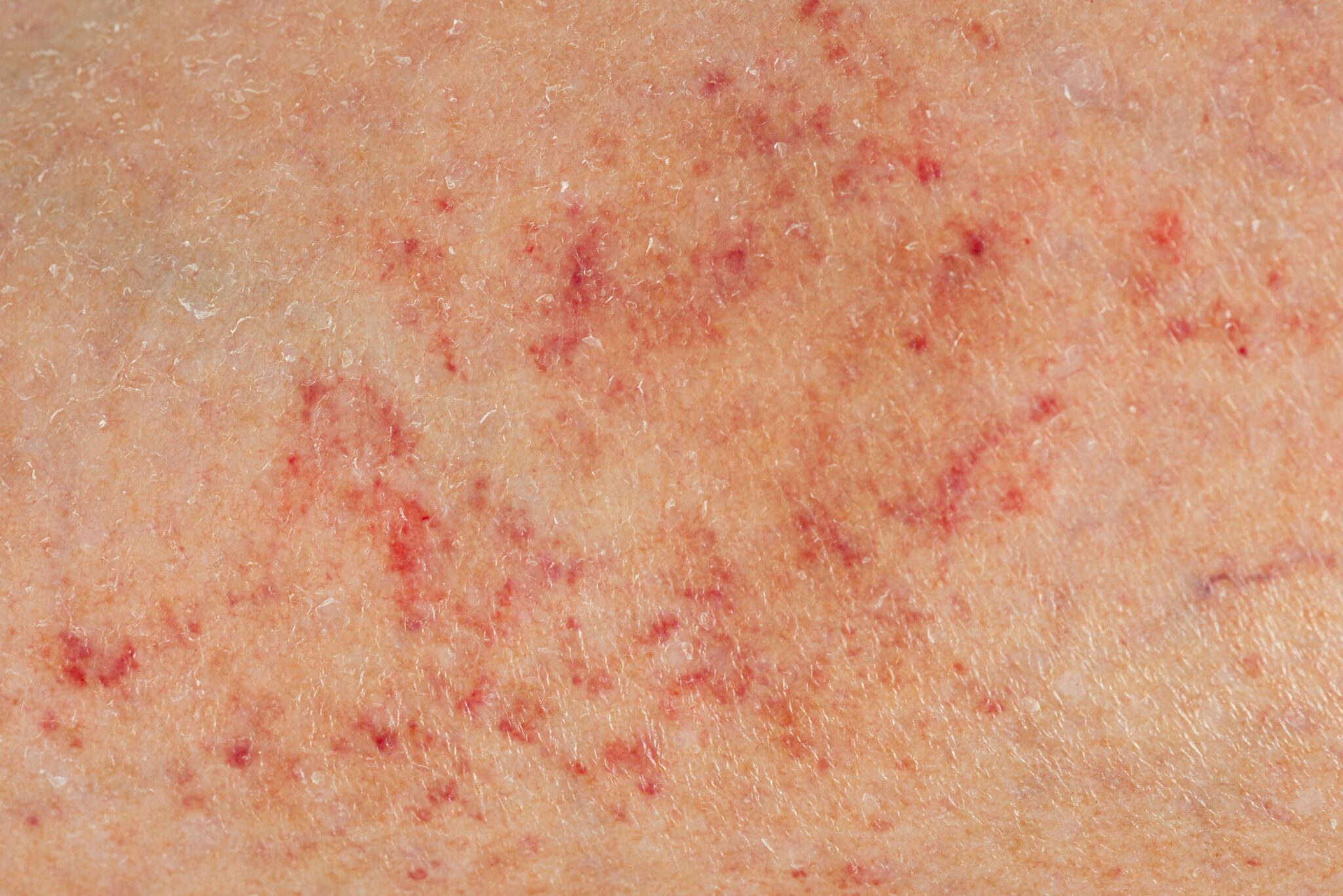 Petechiae: Learn The Symptoms, Causes, and Treatments - K Health