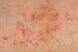 Petechiae: Learn The Symptoms, Causes, and Treatments - K Health